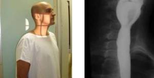 Radiografia da Hipofaringe, Saiba Tudo Sobre o Exame