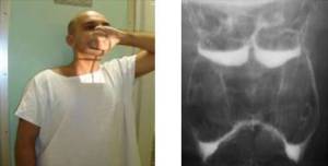 Radiografia da Hipofaringe, Saiba Tudo Sobre o Exame